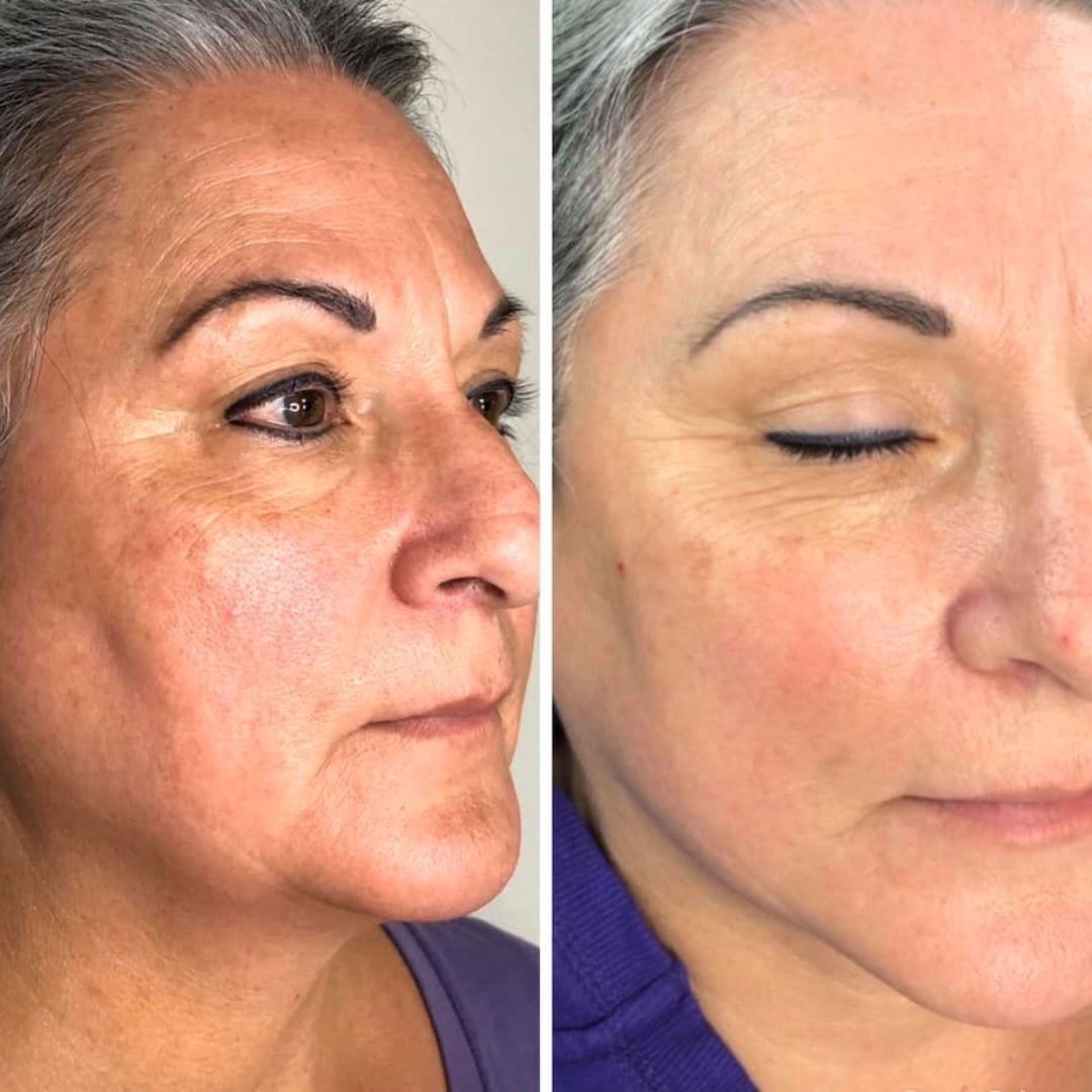 Procell Microchanneling - Elite Esthetics™ Gainesville FL